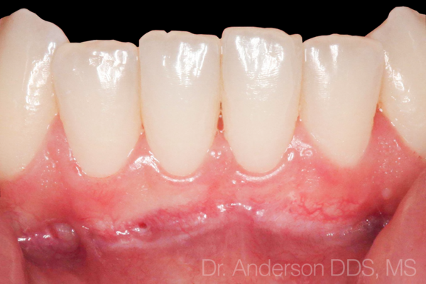 Recession Cases – Aurora Periodontics & Implant Dentistry