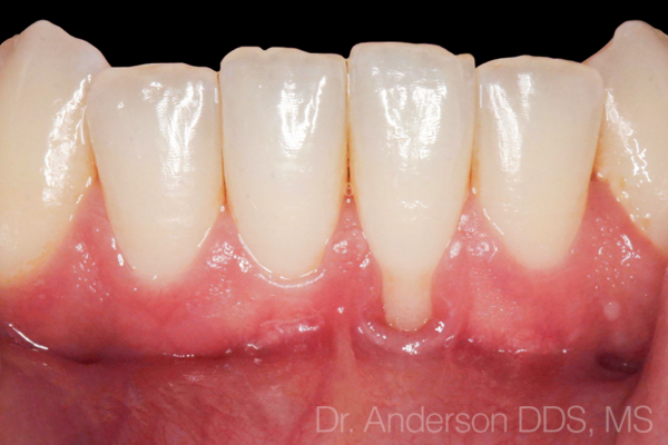 Recession Cases – Aurora Periodontics & Implant Dentistry