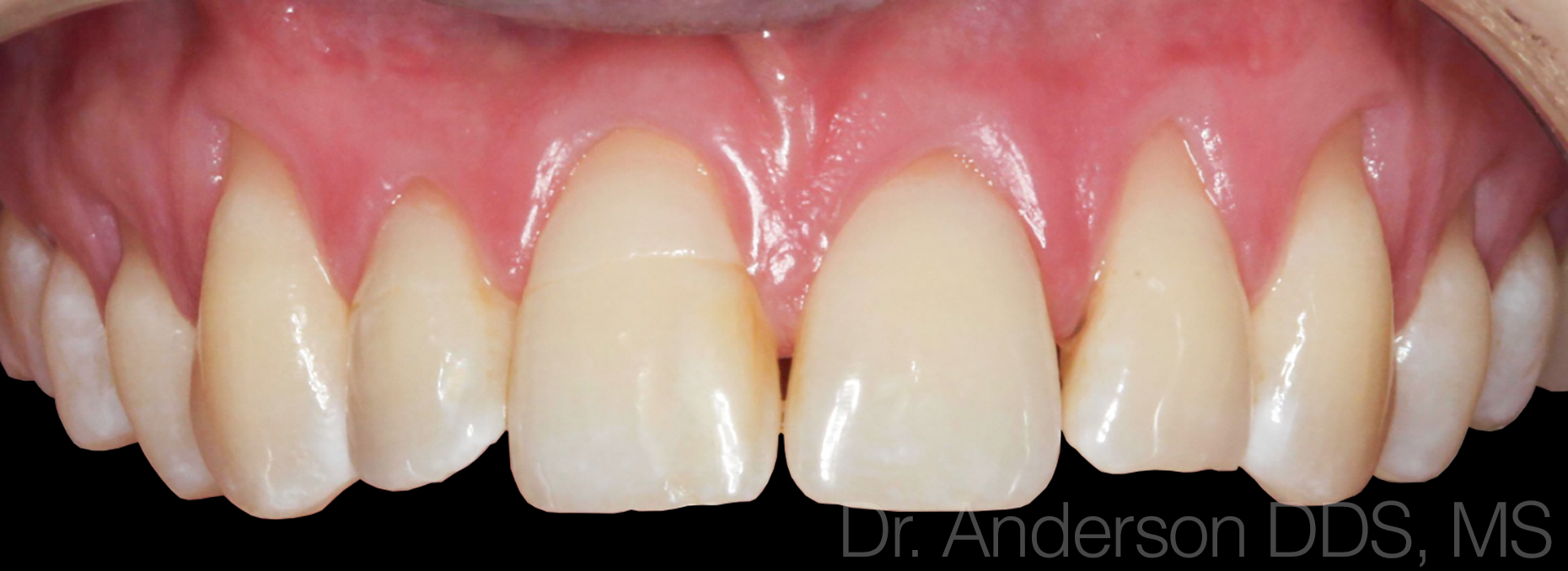 Recession Cases – Aurora Periodontics & Implant Dentistry