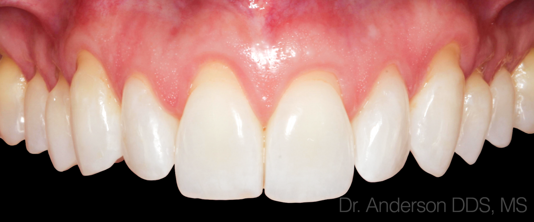 Recession Cases – Aurora Periodontics & Implant Dentistry